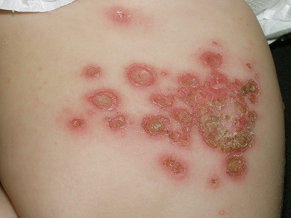 Bacteria que hace heridas en la piel | Portugalessence.com
